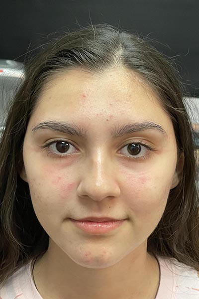 How DMK Enzyme Facials Helps to Clear Acne Breakouts - Skin Care