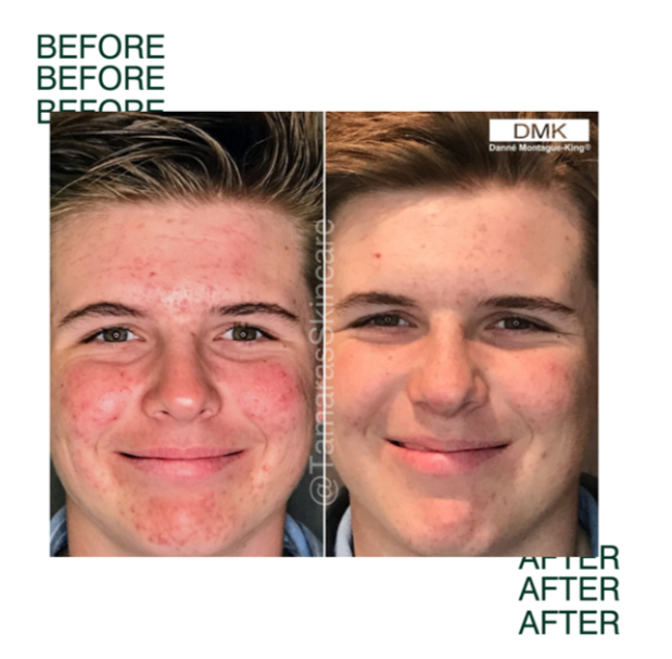 Unlocking the Secrets: Effective DMK Enzyme Acne Treatments Revealed ...