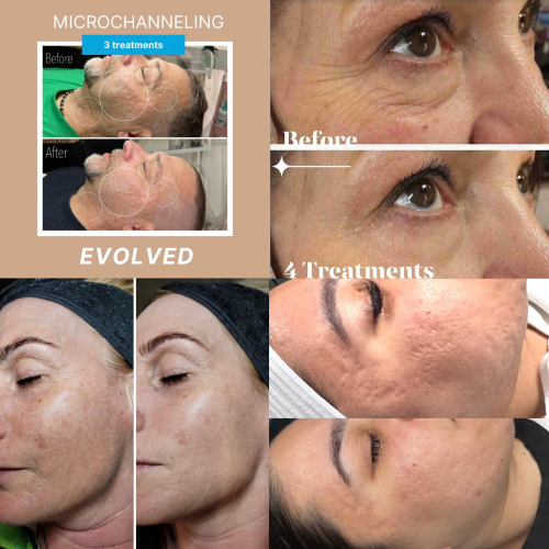 Microneedling vs. Microchanneling: Which Skin Treatment is Right for ...