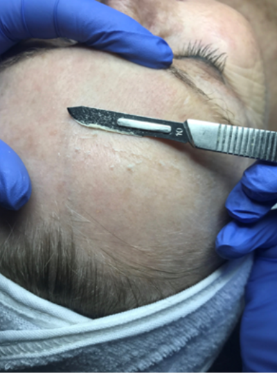 Dermaplaning Facials Unveiled: Benefits and Side Effects You Should ...