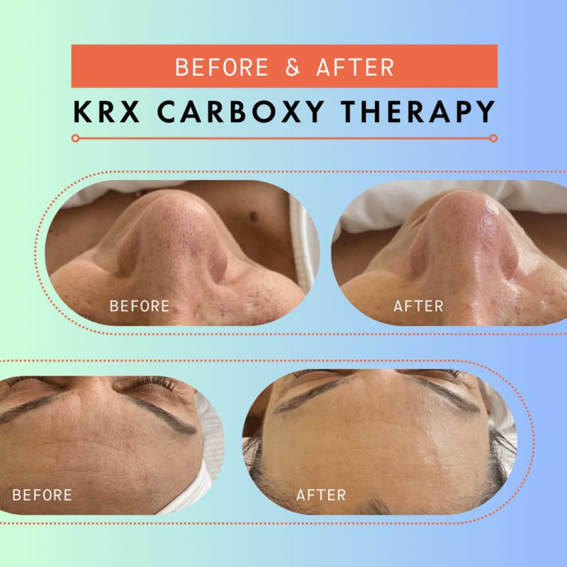 Carboxy Facials - Skin Care