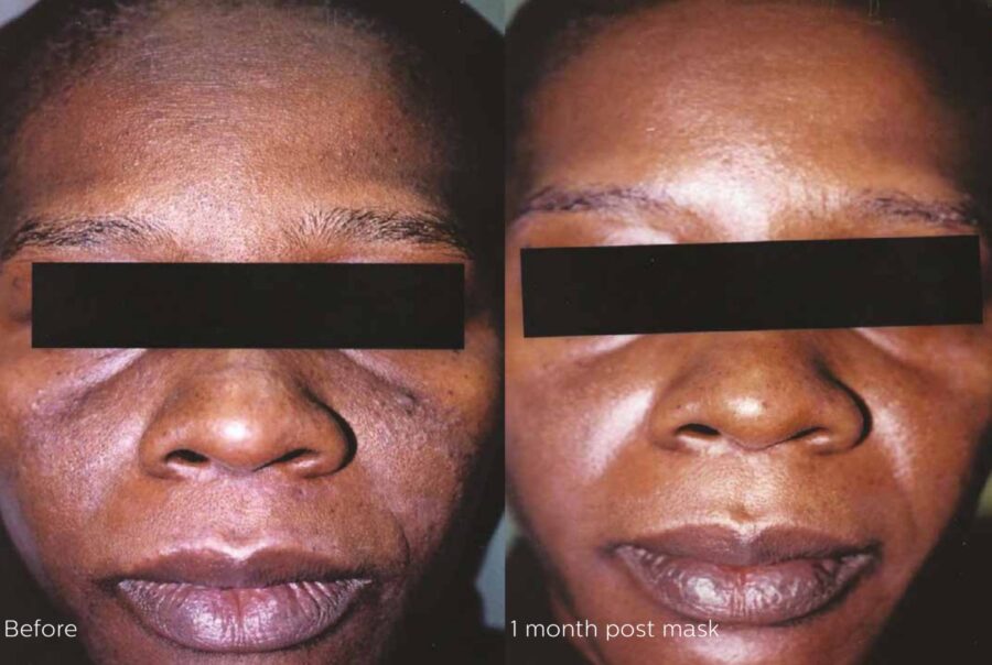 Cosmelan Treatment for Hyperpigmentation - Skin Care