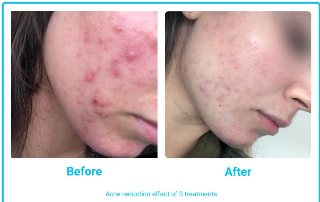 Dr. Platon Cold Plasma: Transforming Skin Care - Skin Care